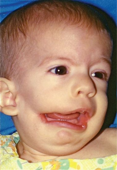 CRANIOFACIAL CLEFTS AND HYPERTELORBITISM - Plastic surgery