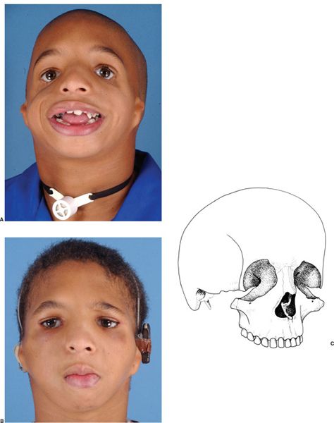 CRANIOFACIAL CLEFTS AND HYPERTELORBITISM - Plastic surgery