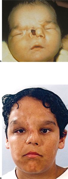 CRANIOFACIAL CLEFTS AND HYPERTELORBITISM - Plastic surgery