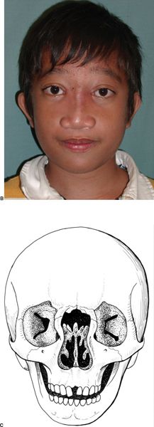 CRANIOFACIAL CLEFTS AND HYPERTELORBITISM - Plastic surgery