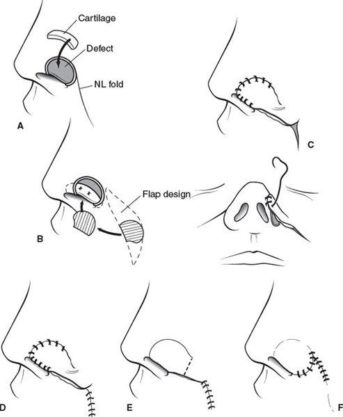 NASAL RECONSTRUCTION - Plastic surgery
