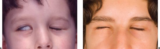 FACIAL PARALYSIS - Plastic surgery