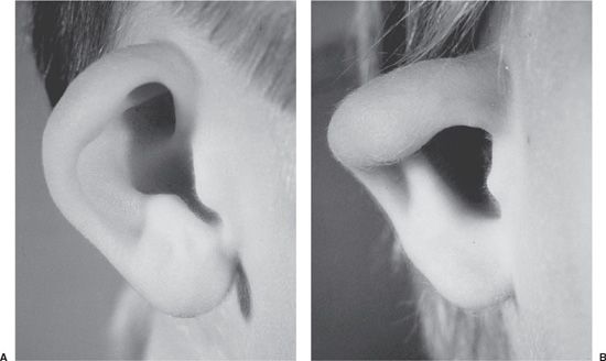 OTOPLASTY - Plastic surgery