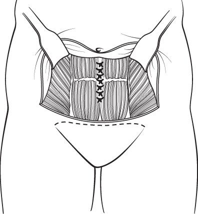 ABDOMINOPLASTY AND BELT LIPECTOMY - Plastic surgery