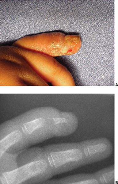 TREATMENT OF HAND INFECTIONS - Plastic surgery