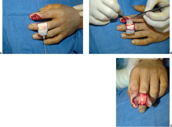 SOFT TISSUE RECONSTRUCTION OF THE UPPER EXTREMITY - Plastic surgery