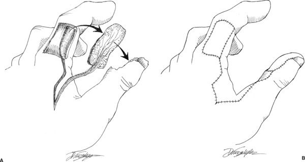 SOFT TISSUE RECONSTRUCTION OF THE UPPER EXTREMITY - Plastic surgery