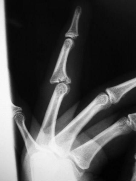 MANAGEMENT OF HAND FRACTURES - Plastic surgery