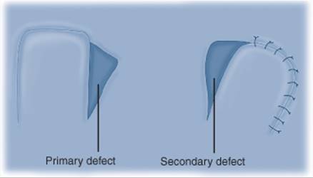 Plastic and Reconstructive Surgery - Specific Considerations - Schwartz ...
