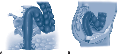 Colon, Rectum, and Anus - Principles of surgery
