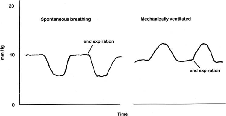 Hemodynamic Monitoring: Arterial and Pulmonary Artery Catheters ...