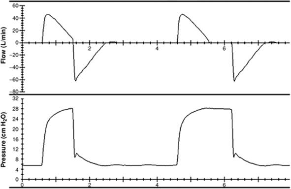 Bedside Interpretation of Ventilatory Waveforms - Civetta, Taylor ...