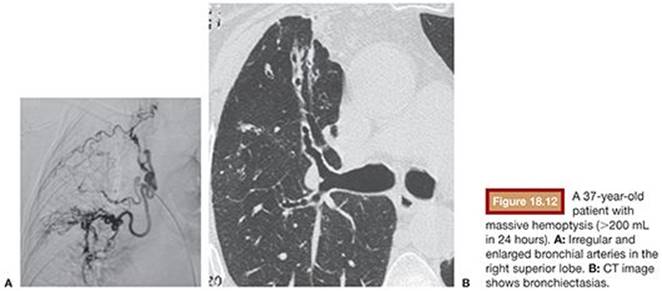 Hemoptysis - Clinical Applications - Embolization Therapy: Principles ...