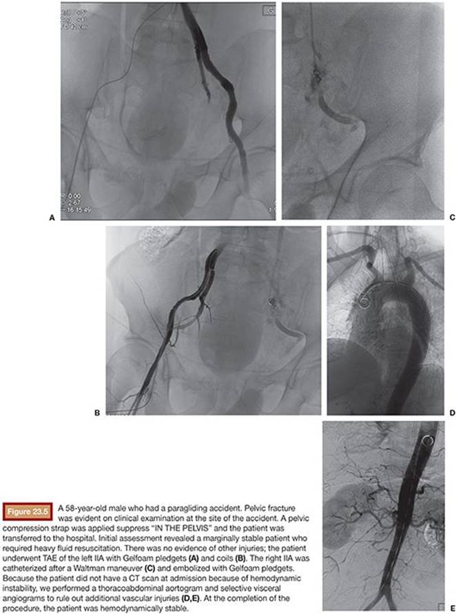 Pelvic Trauma - Clinical Applications - Embolization Therapy ...