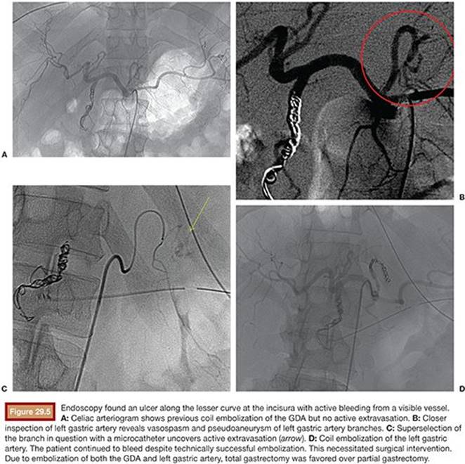 Upper Gastrointestinal Bleeding - Clinical Applications - Embolization ...