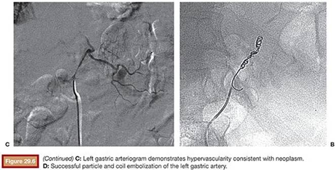 Upper Gastrointestinal Bleeding - Clinical Applications - Embolization ...
