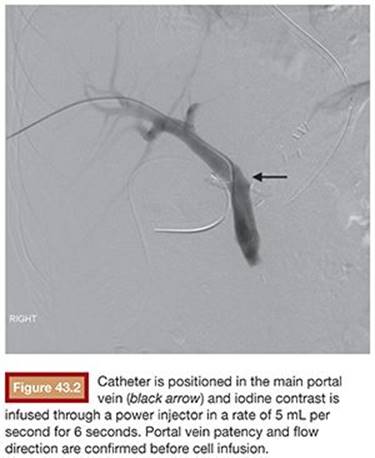 Hepatopancreatic Disease - Clinical Applications - Embolization Therapy ...