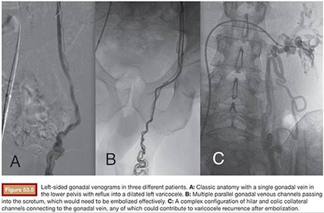 Varicocele - Clinical Applications - Embolization Therapy: Principles ...