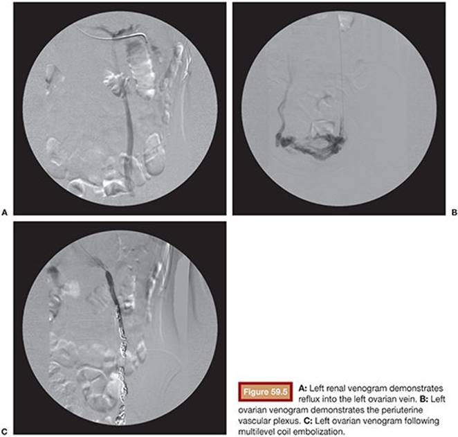 Pelvic Congestion Syndrome - Clinical Applications - Embolization ...