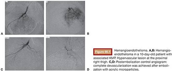 Pediatric Embolization - Clinical Applications - Embolization Therapy ...