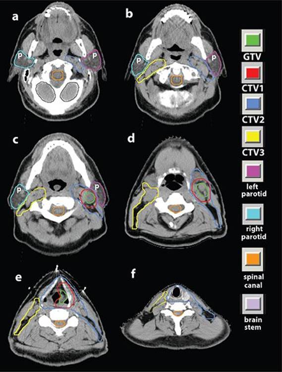 Hypopharynx and Larynx - Practical Essentials of Intensity Modulated ...