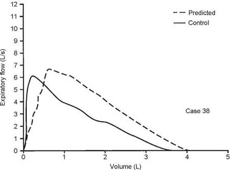 Illustrative Cases - Interpretation of Pulmonary Function Tests A ...