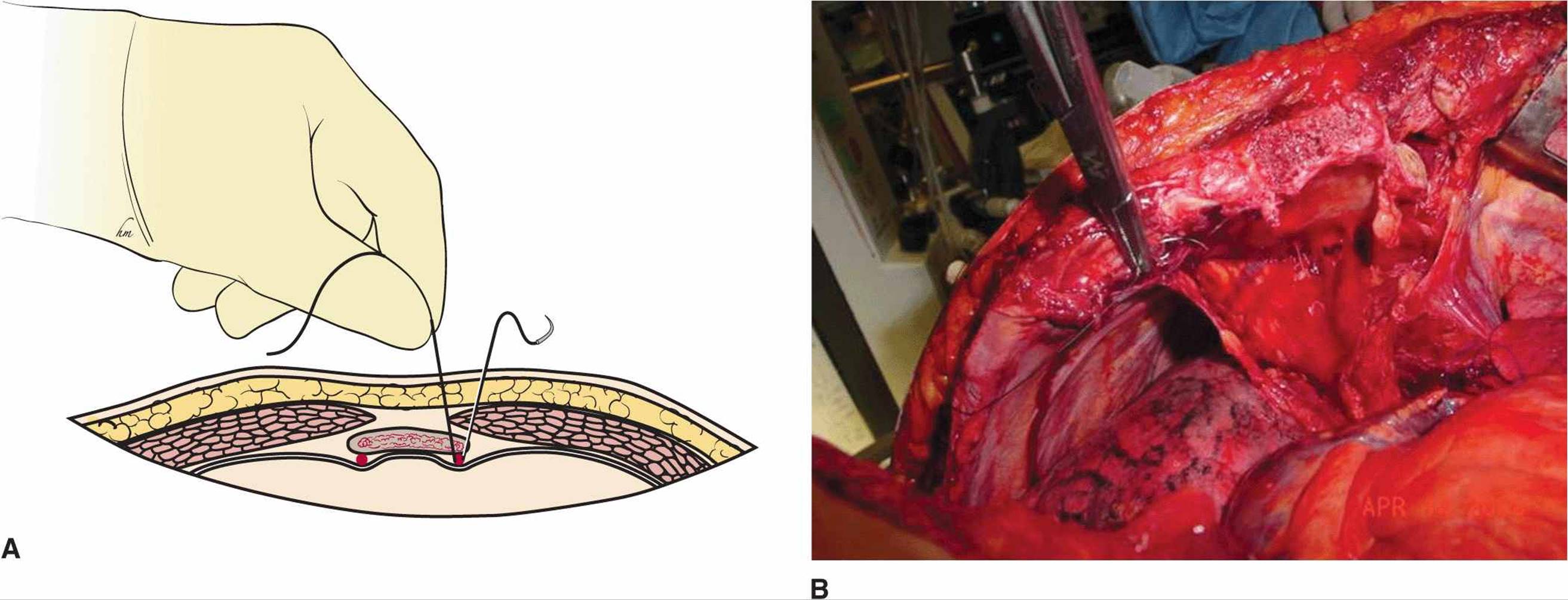 Emergency Department Thoracotomy - Trauma, 7th Ed.