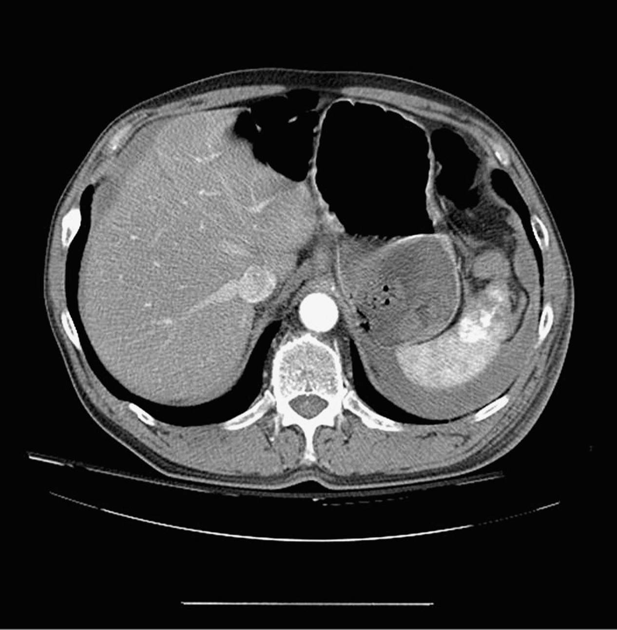 Injury to the Spleen - Trauma, 7th Ed.