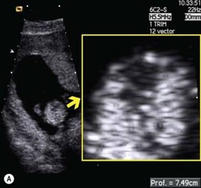 First-trimester cardiac scan and study - Fetal Heart Ultrasound: How ...
