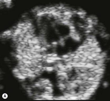 First-trimester cardiac scan and study - Fetal Heart Ultrasound: How ...