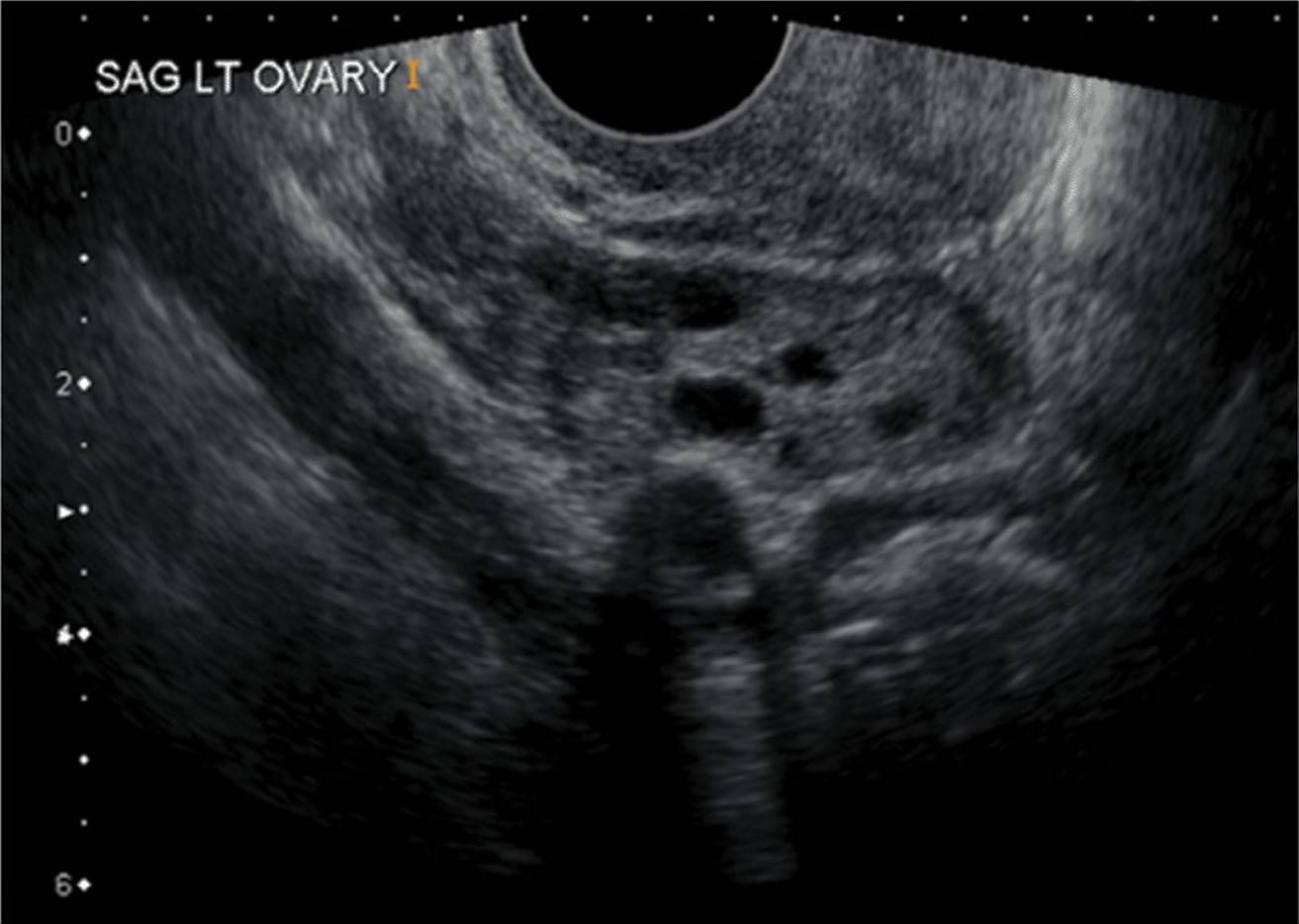 Obstetrical and Gynecologic Sonography and Transvaginal Sonography ...
