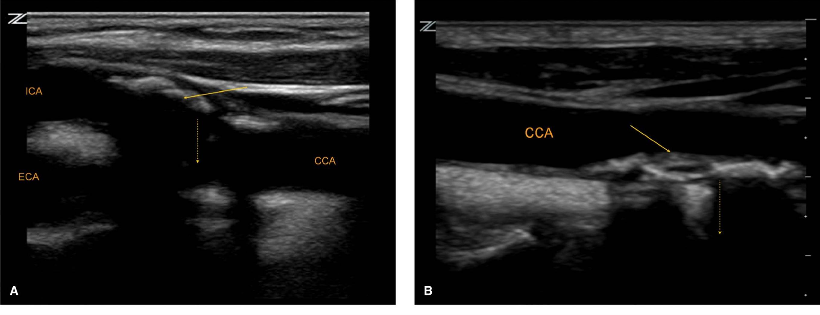 Cerebrovascular Sonography - Lange Review Ultrasonography Examination ...